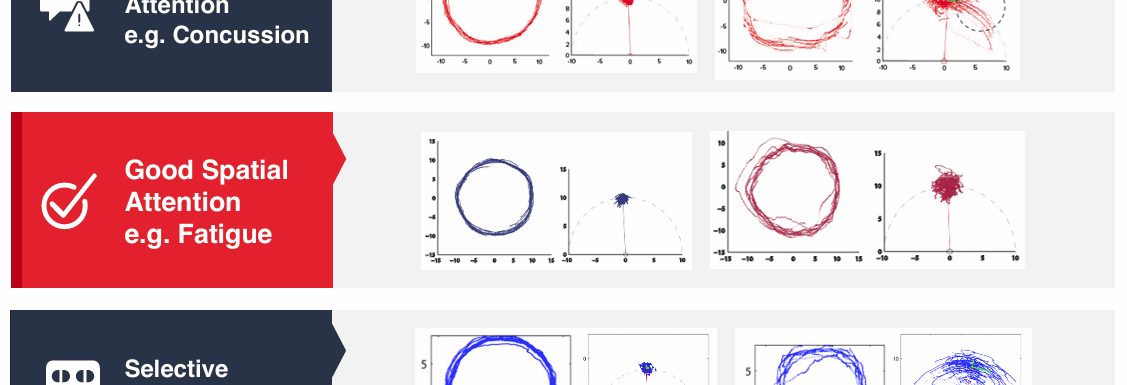 Eye Tracking for ADHD and Concussions - Dr. Sarah Cheyette, MD